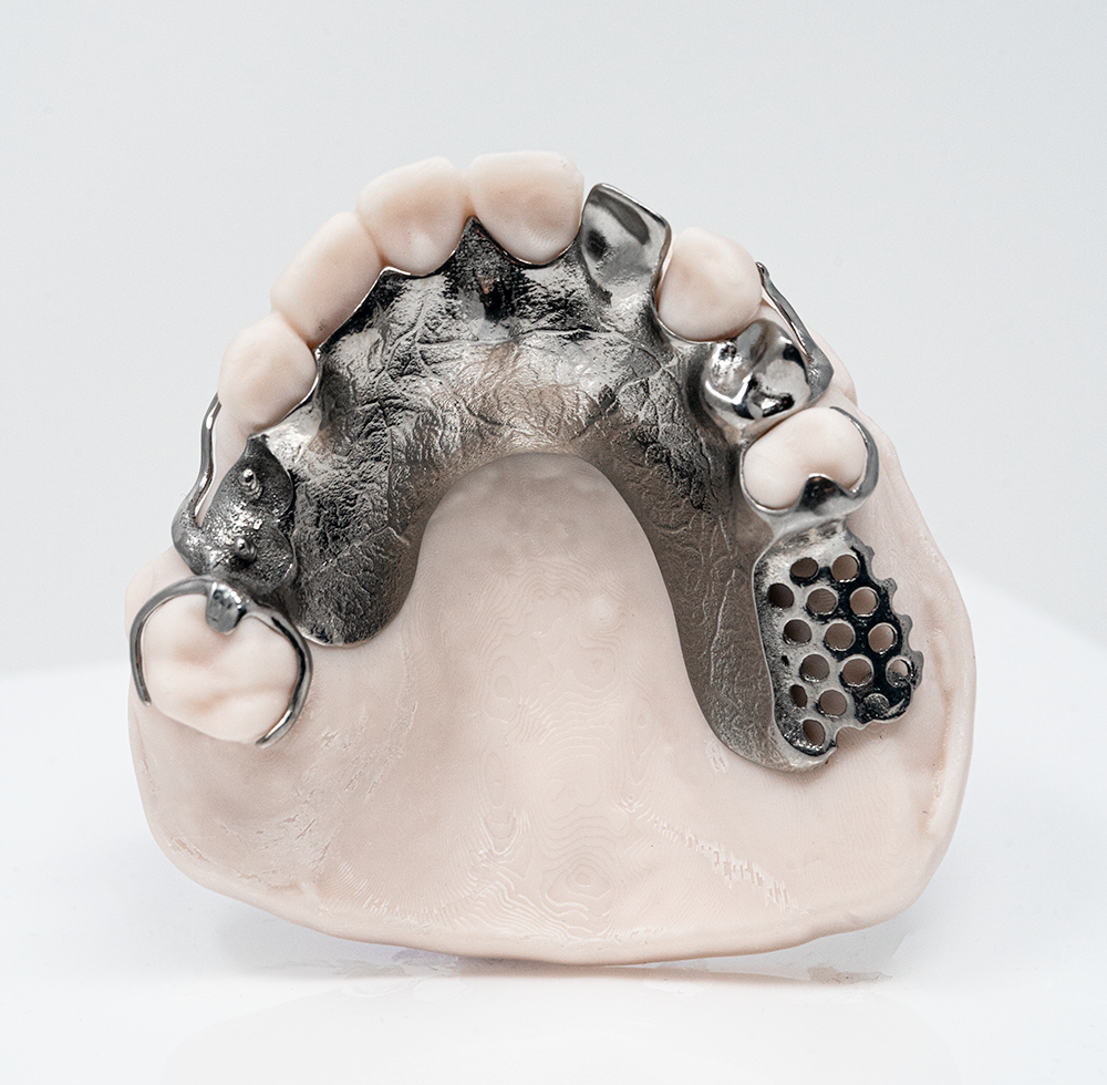 SLM Titanium Partial Dentures